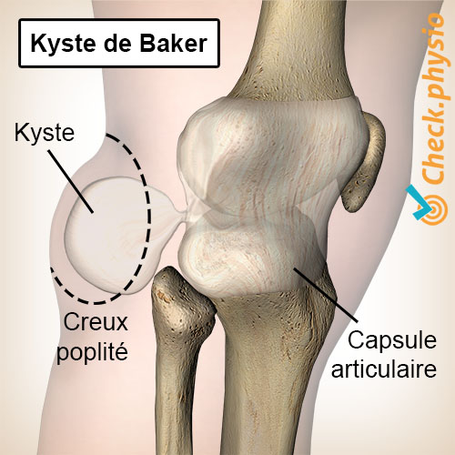 Cause, symptômes et traitement | Kyste de Baker - Physiotest.fr