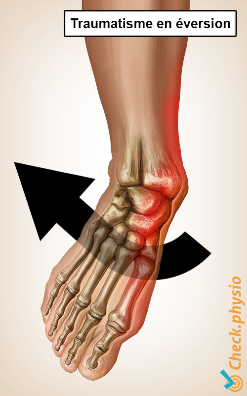 Lésion du ligament interne de la cheville