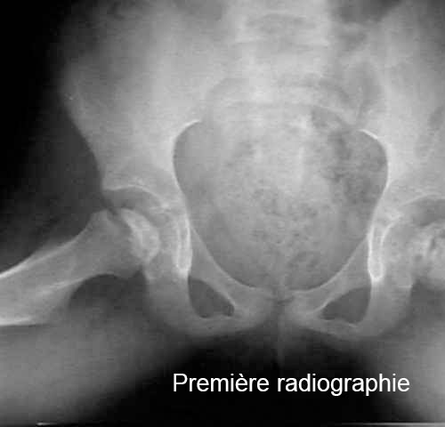 Maladie de Calvé-Legg-Perthes | Cause, symptômes et traitement
