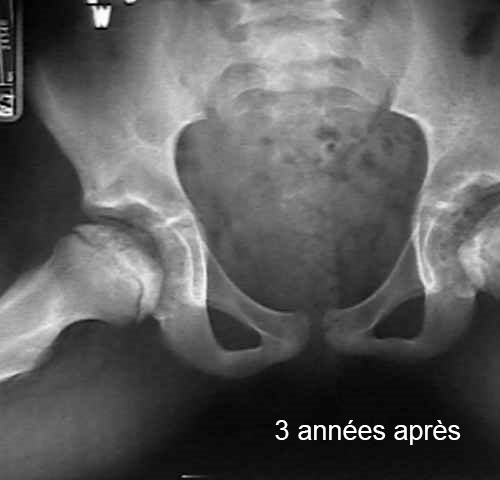 Maladie de Calvé-Legg-Perthes | Cause, symptômes et traitement